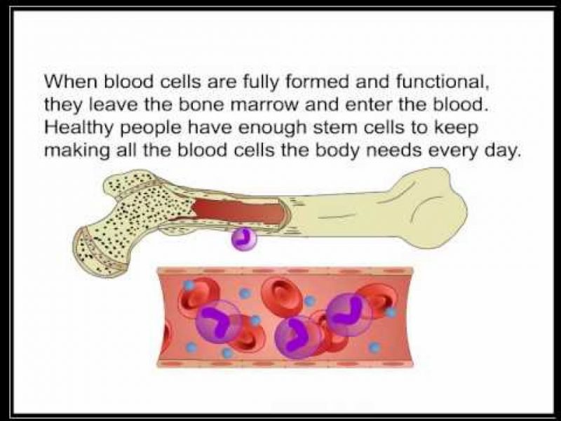 Sel Punca Darah Tali Pusat untuk Myelodysplastic Syndromes