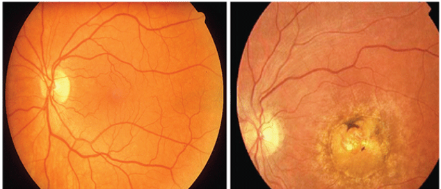 Retinitis Pigmentosa - PT Prodia StemCell Indonesia